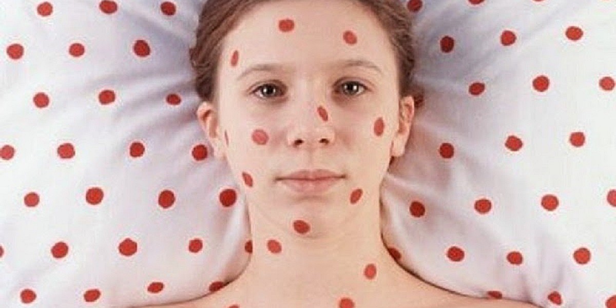 Morbillo e pertosse in crescita, chi rischia e chi deve vaccinarsi. Il ...
