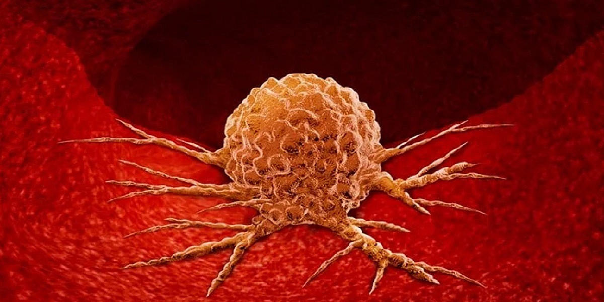 Colangiocarcinoma, diagnosi tardiva per il 70% dei pazienti | Medicina ...