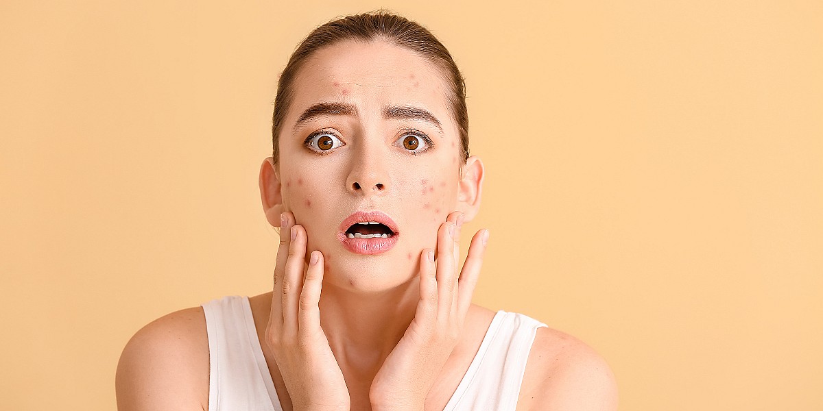 Acne: una guida completa per comprenderla, curarla e prevenirla ...