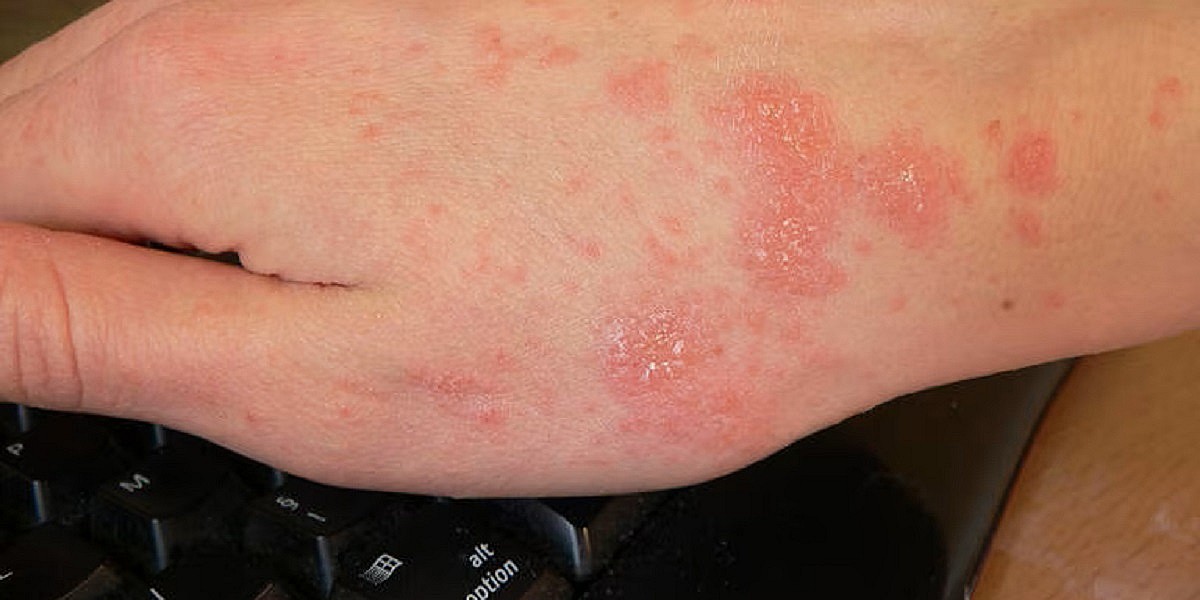 Scabbia, picchi di casi in Italia dopo la pandemia. Ecco i sintomi da ...