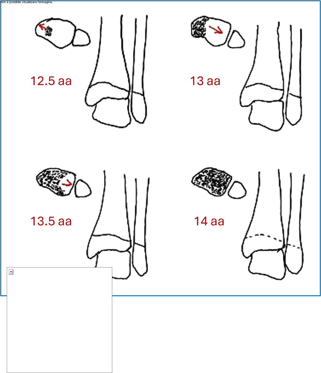 Traumatologia del piede e della caviglia: i distacchi epifisari ...