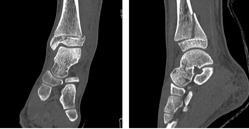 Traumatologia del piede e della caviglia: i distacchi epifisari ...